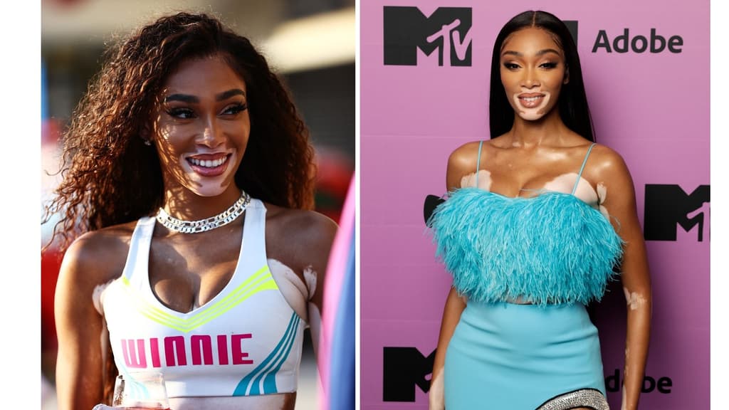 Winnie Harlow: la modelo con vitiligo que rompió estándares de belleza ...