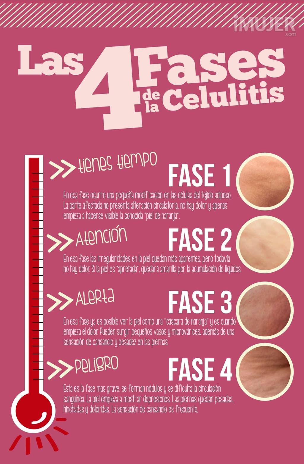 Infografía: Todo sobre la celulitis | Estilo de Vida Belleza | Univision
