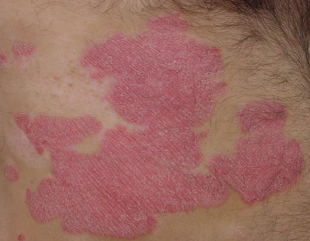 La psoriasis infantil y su tratamiento | Estilo de Vida Madres | Univision