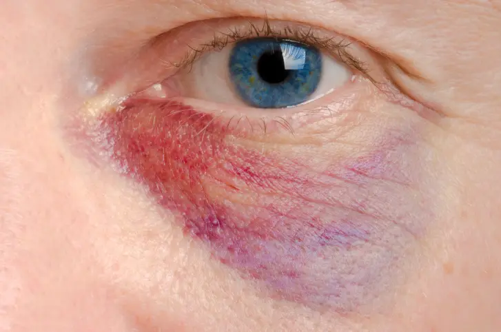 ¿Por qué los hematomas cambian de color? | Explora | Univision