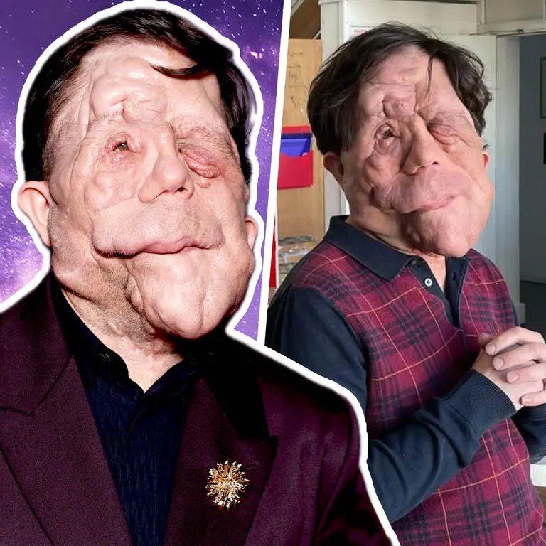 Adam Pearson, el actor de Un hombre diferente responde a su deformación ...