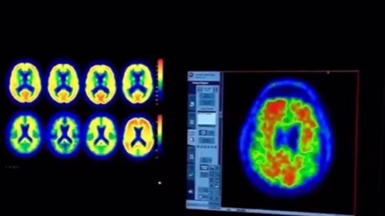 La innovadora terapia para combatir la depresión de la Universidad de ...