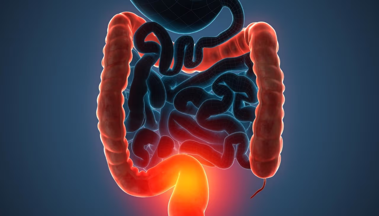 Cáncer de colon aumentó en menores de 50 años en EEUU (y no se sabe por ...