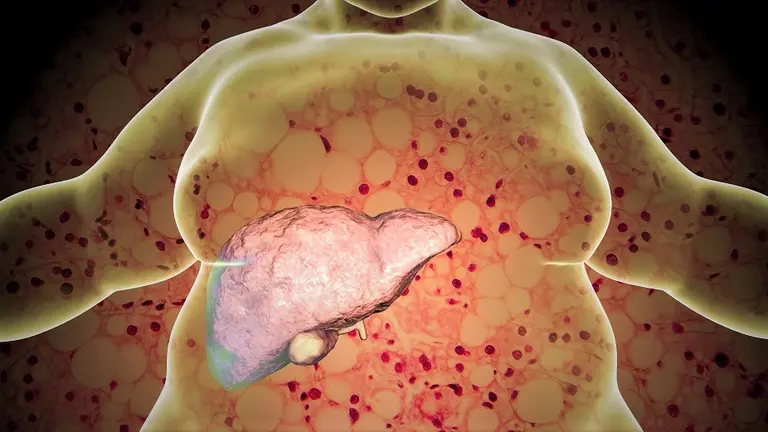 ¿Qué es el hígado graso? Síntomas y recomendaciones para combatir este ...