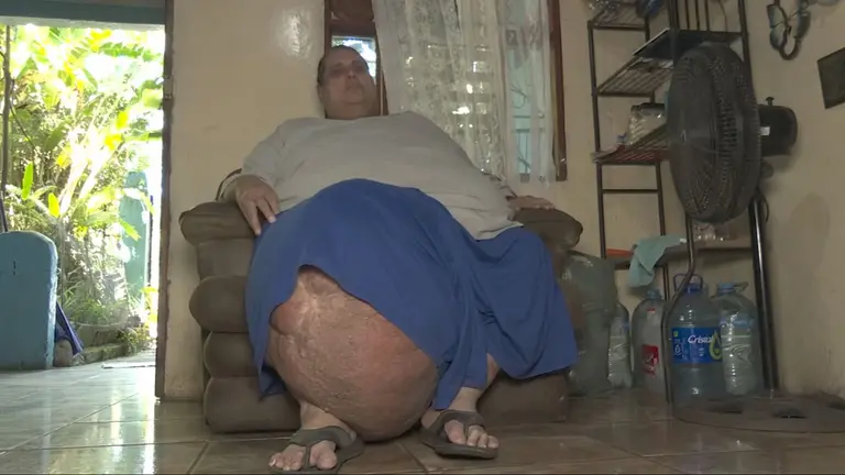 Hombre postrado por un tumor de 40 kilos espera cirugía tras 15 años de lucha | Shows Primer ...